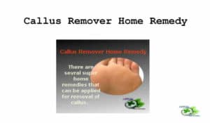 How to Get Rid of Calluses on Feet: 11 Best Remedies