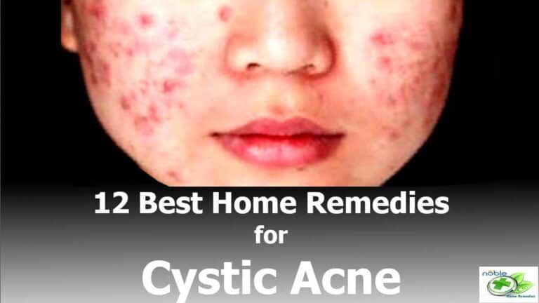 Get Rid of Cystic Acne:12 Best Home Remedies