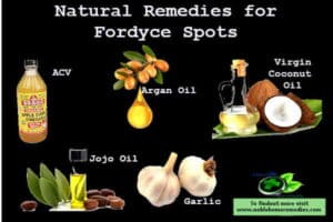 How to Get Rid of Fordyce Spots: 5 Effortless Home Remedies