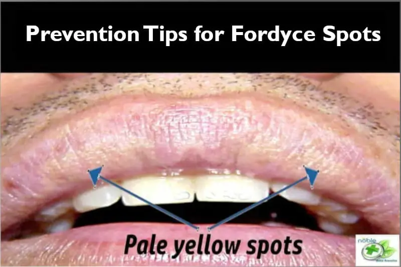 6 Proven Tips On Fordyce Spots Prevention You Should Try 